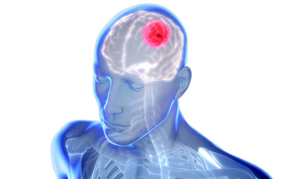 Cáncer cerebral: Científicos logran frenar el crecimiento de un tumor