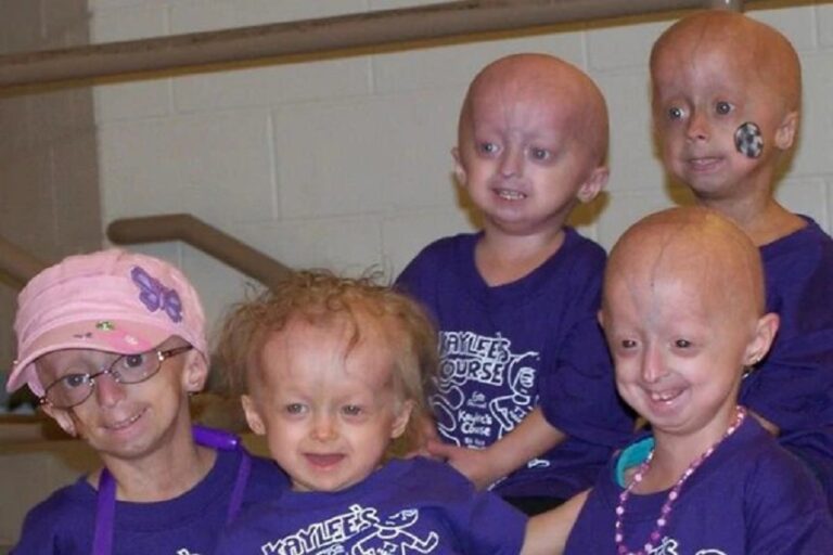 Zokinvy aumenta la esperanza de vida a niños con síndrome de progeria