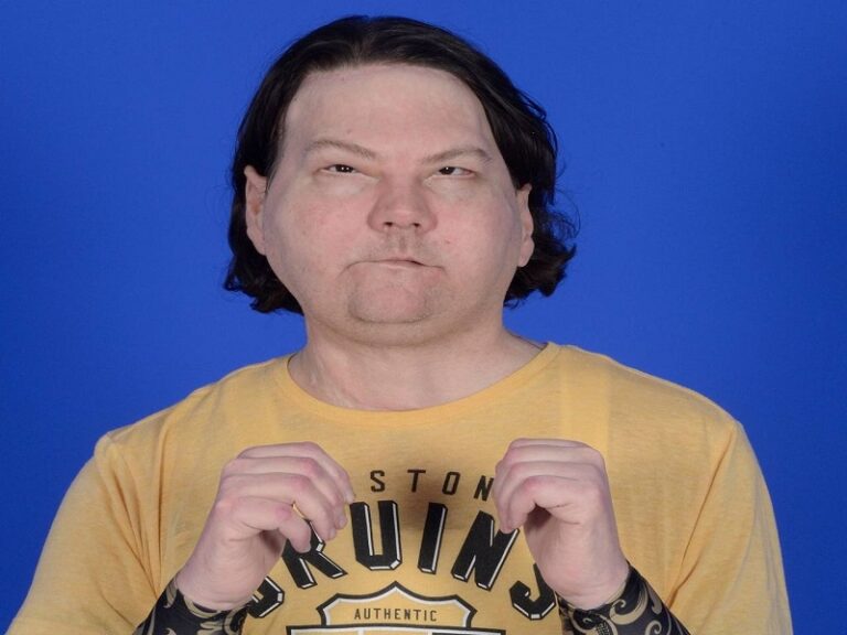 Joe DiMeo, la primera persona en recibir exitoso trasplante de cara y manos