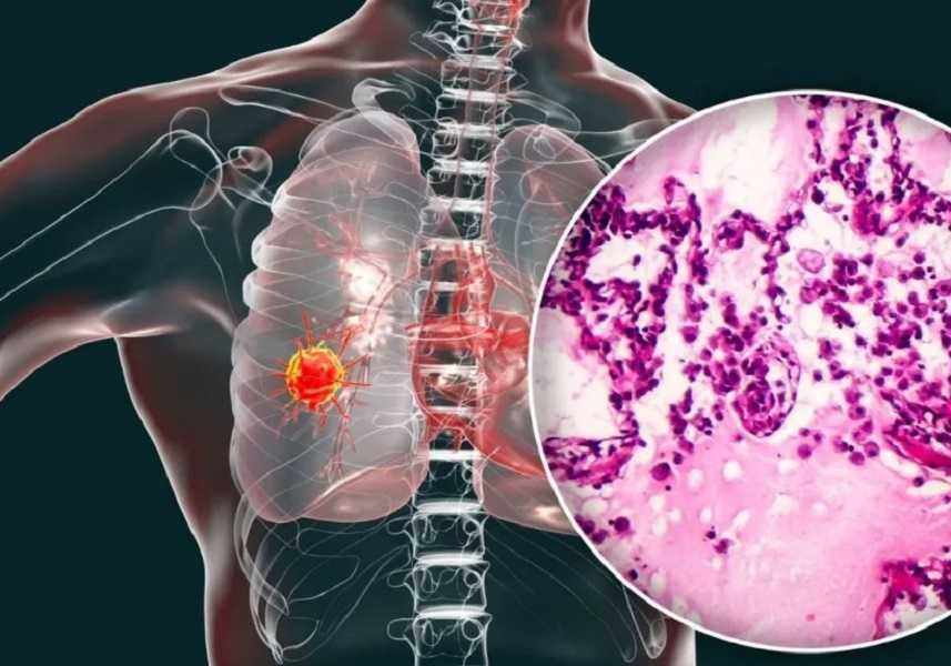 Cáncer de pulmón: conoce los signos que lo delatan en su inicio temprano