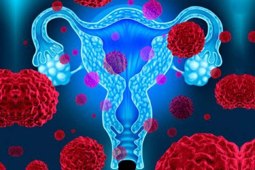 Cáncer de cuello uterino: conoce los síntomas de alarma