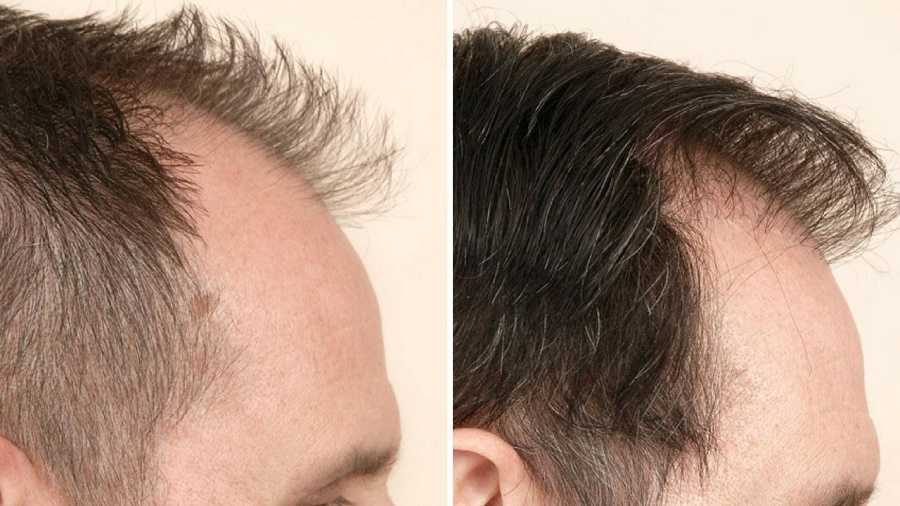 5 secretos para vencer la calvicie en 92 días - CURADAS